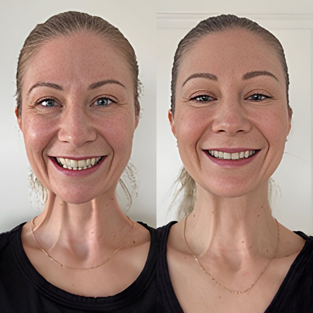 Botox Helsinki ja Vantaa - Ebeling Kauneus